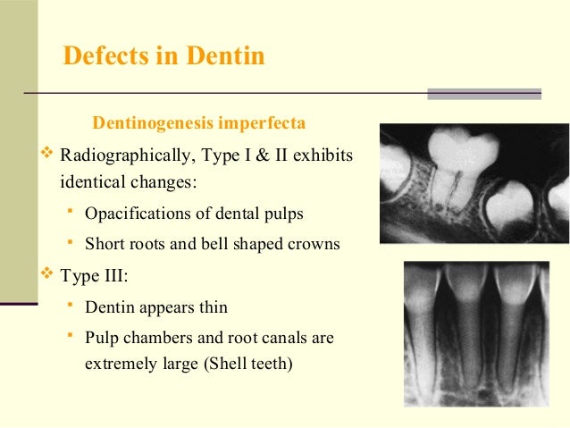 Teeth abnormalities ii
