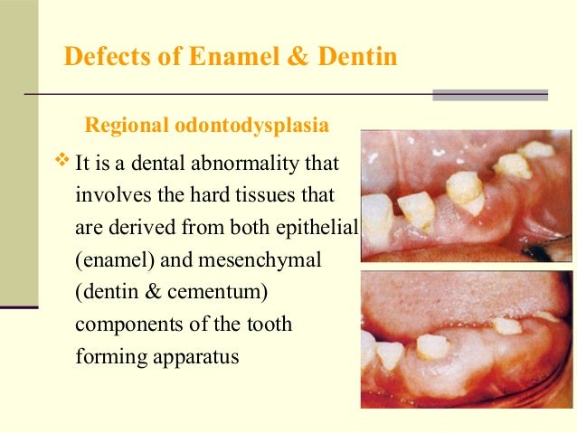 Teeth abnormalities ii