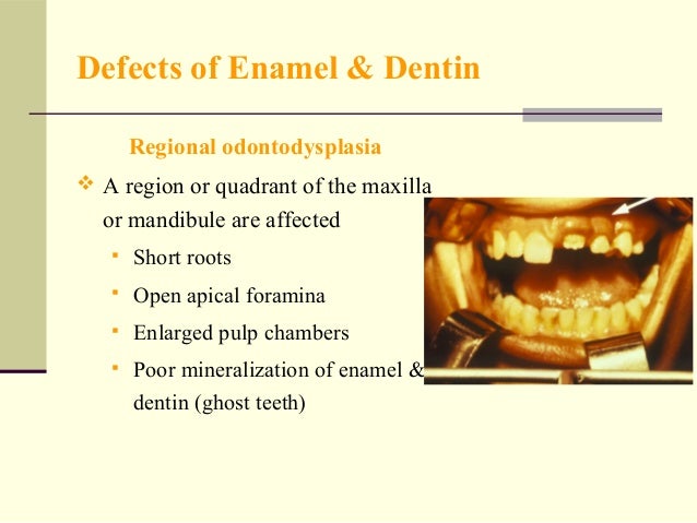 Teeth abnormalities ii