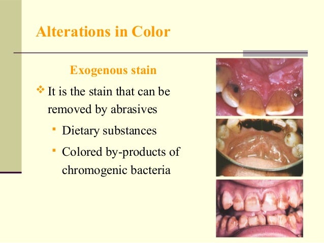 Teeth abnormalities ii