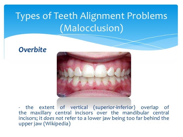 Teeth Alignment Problems or Malocclusion by Richmond Family Dentist