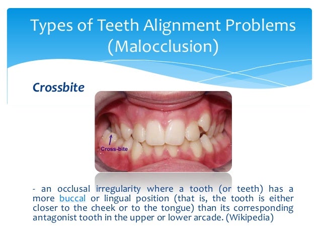Teeth Alignment Problems or Malocclusion by Richmond Family Dentist
