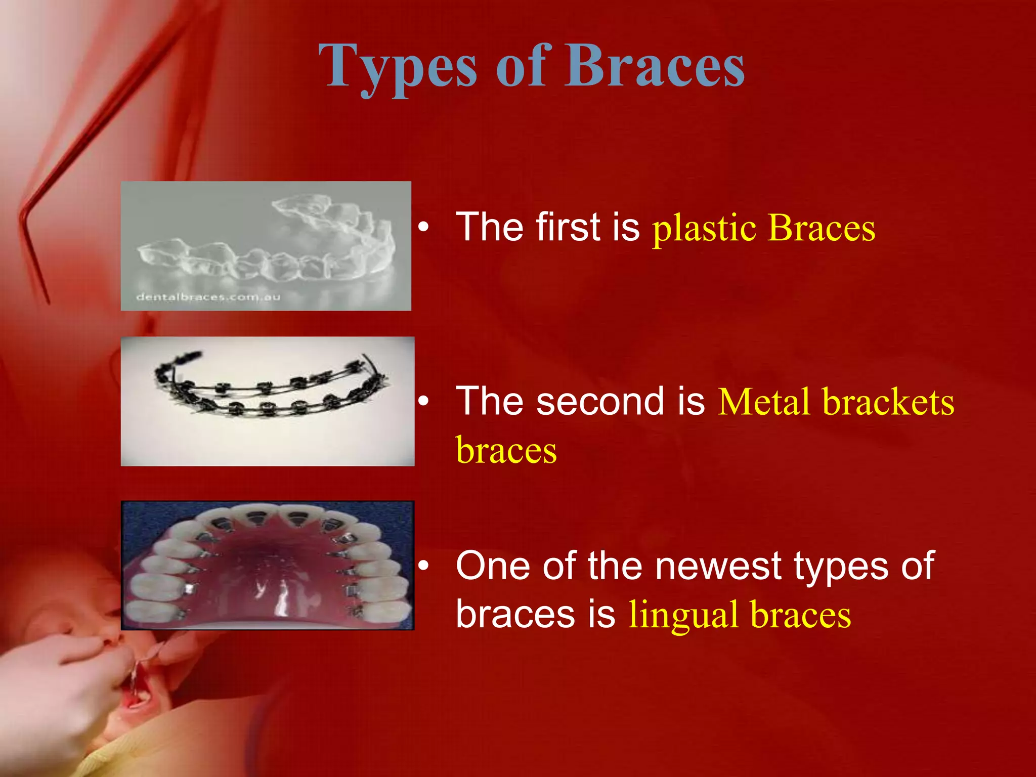 Teeth braces | PPTX
