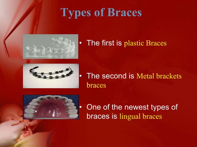 Teeth braces | PPTX | Oral care | Personal Care