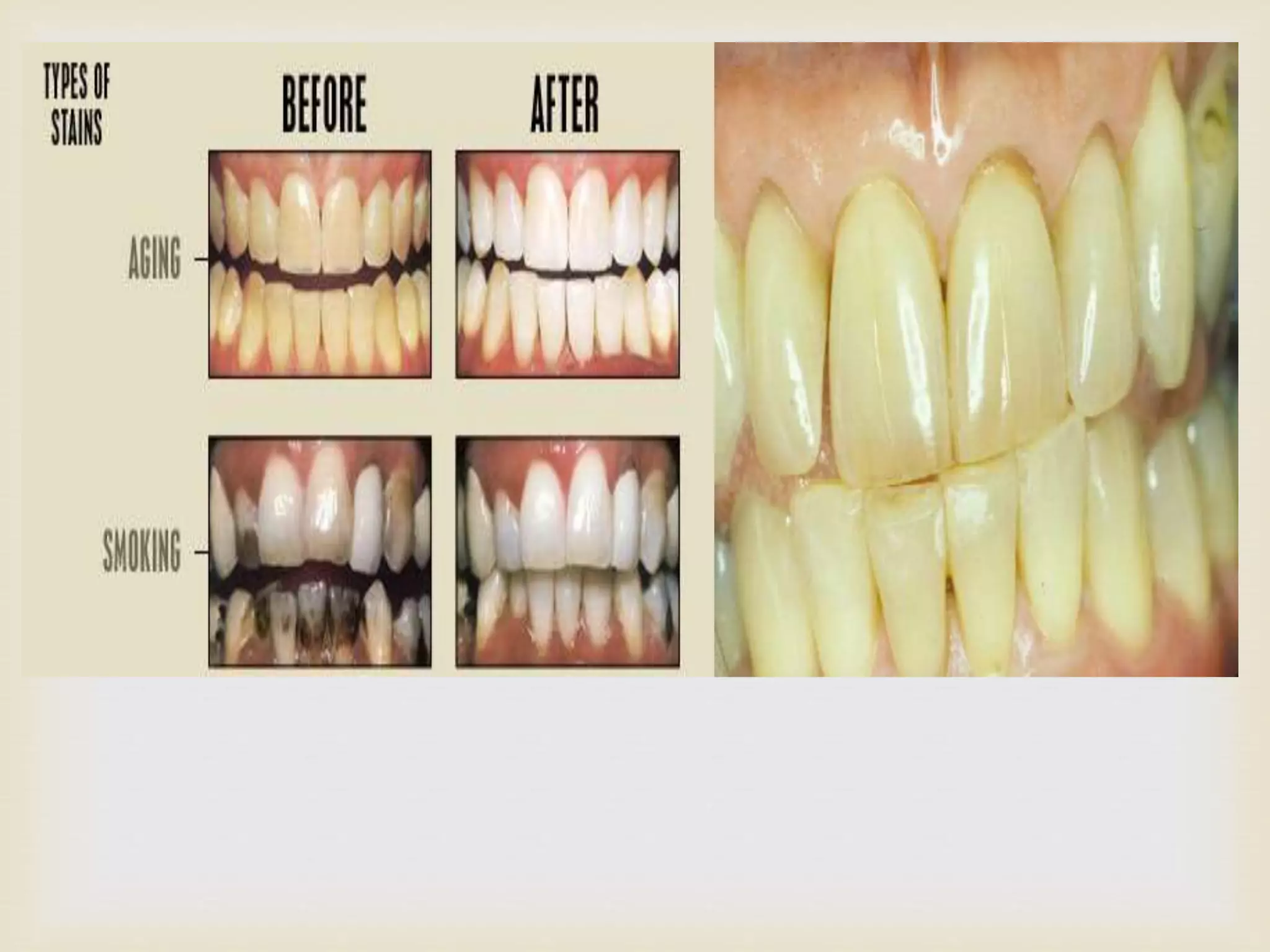 Teeth discoloration | PPTX