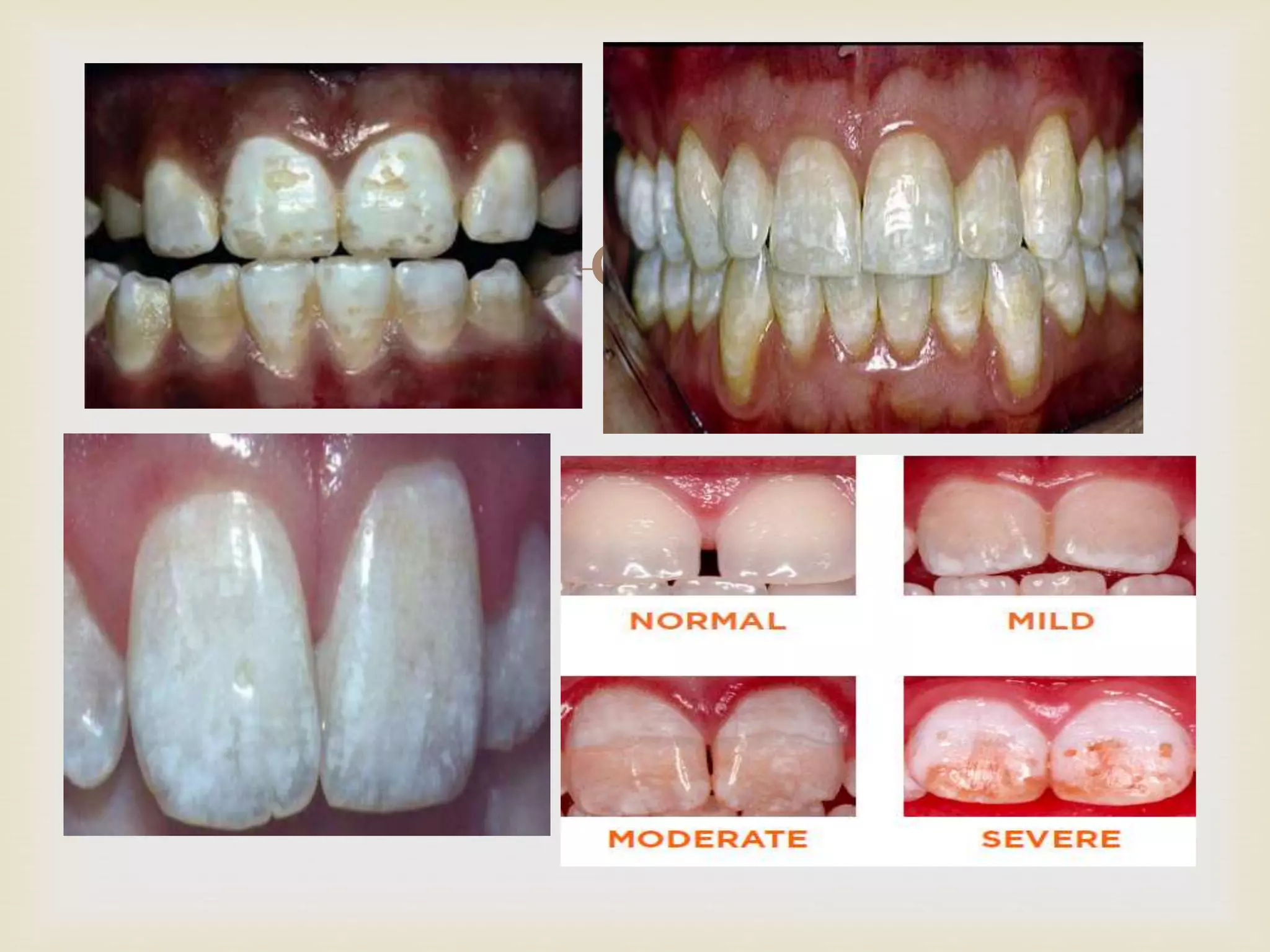 Teeth discoloration | PPTX
