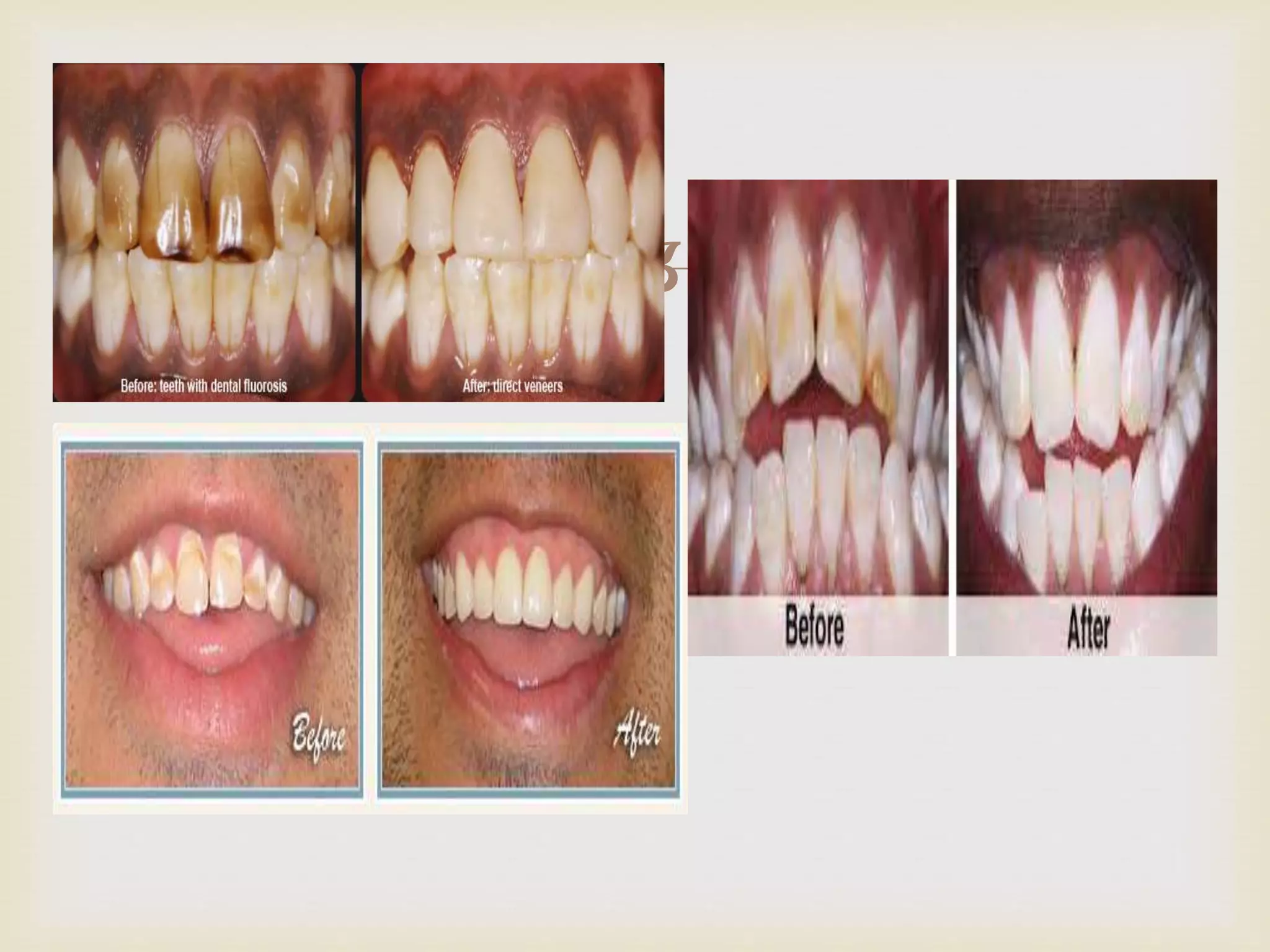 Teeth discoloration | PPTX