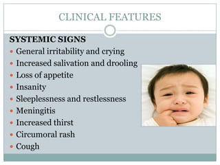 Teething | PPTX