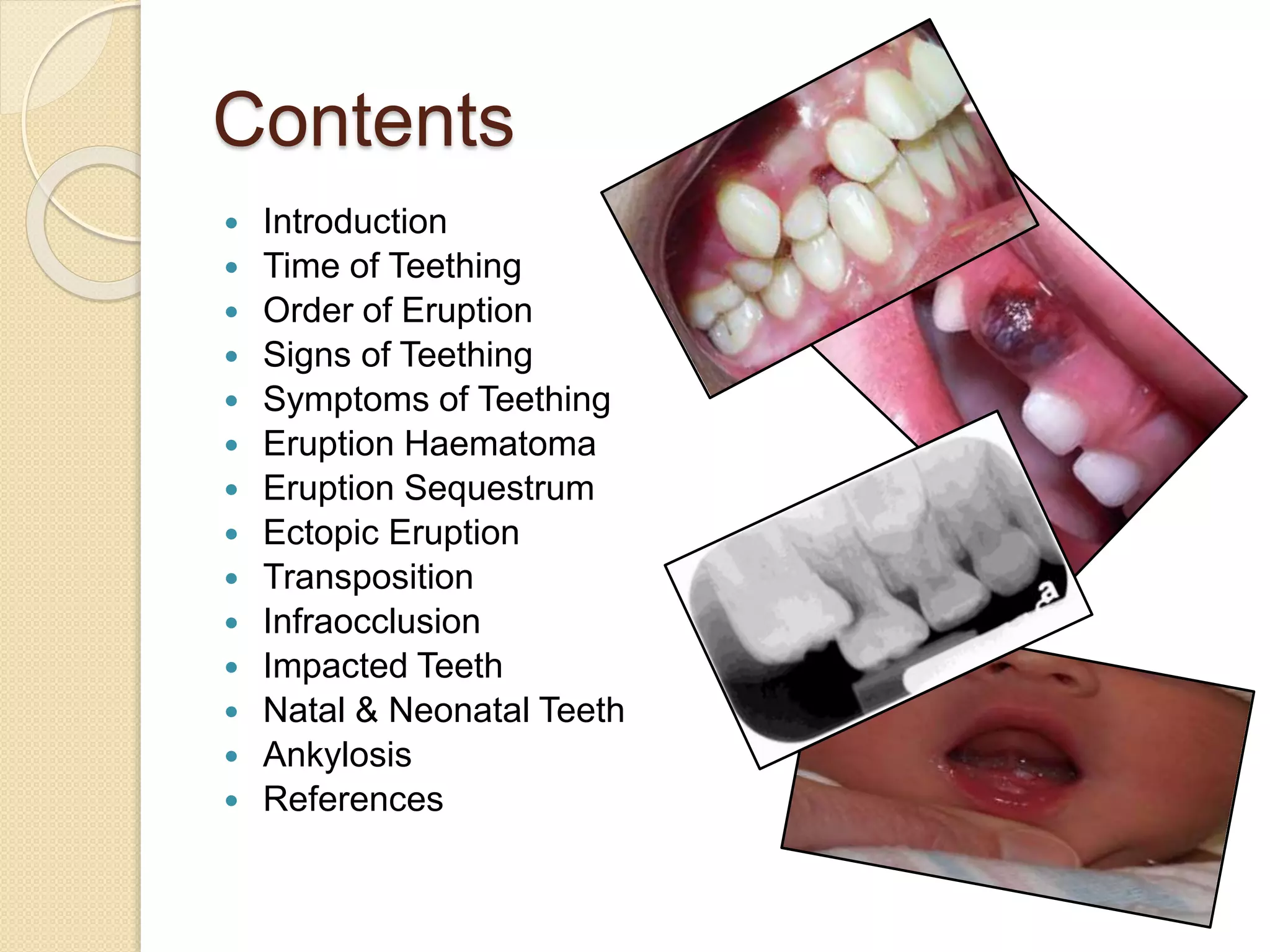Teething problems & management | PPTX