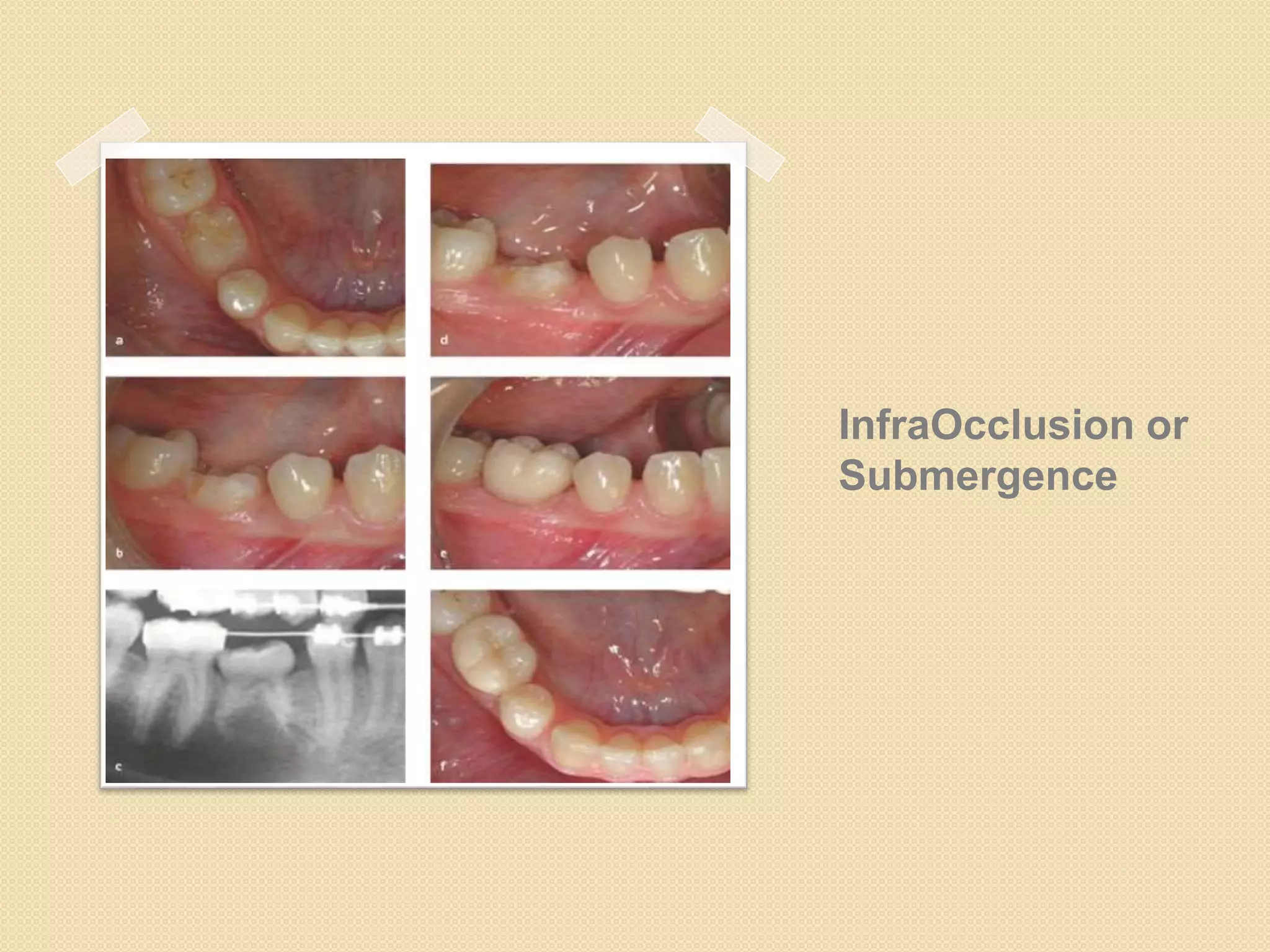 Teething problems & management | PPTX