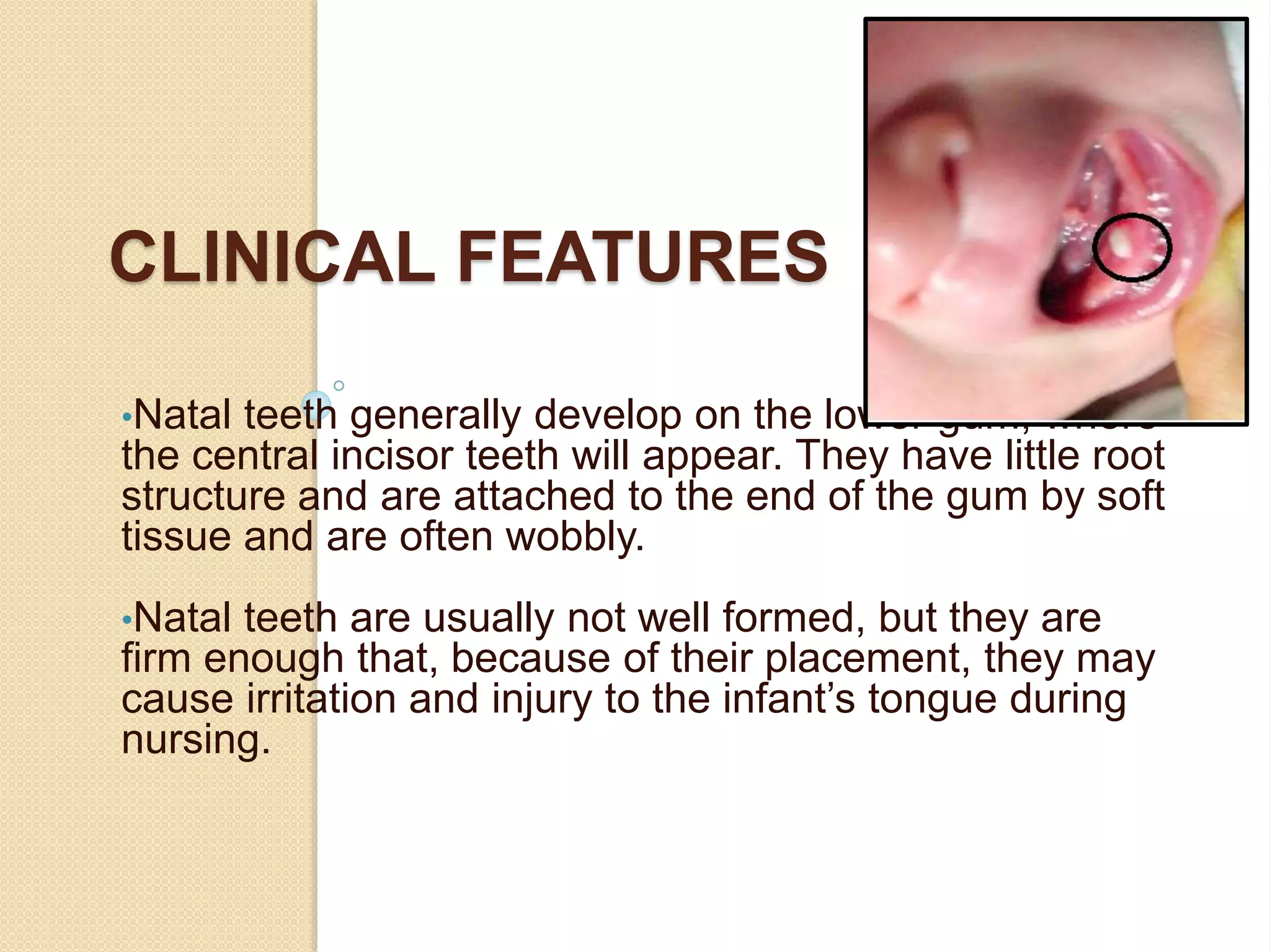 Teething problems & management | PPTX