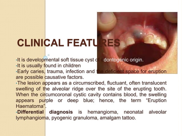 Teething problems & management | PPTX | Dental Health | Diseases and Conditions