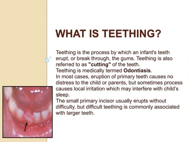 Teething problems & management | PPTX | Dental Health | Diseases and Conditions
