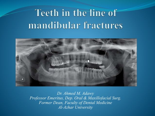 Teeth in The Line of Mandibular Fractures | PPT