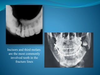 Teeth in The Line of Mandibular Fractures | PPTX