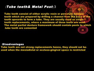 Teeth of Removable Partial Denture | PPT