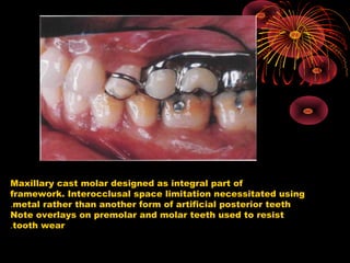 Teeth of Removable Partial Denture | PPT