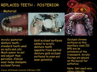 Teeth of Removable Partial Denture | PPT