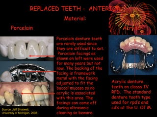 Teeth of Removable Partial Denture | PPT