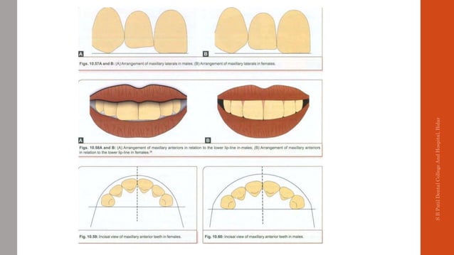 TEETH SELECTION IN COMPLETE DENTURE | PPTX | Dental Health | Diseases ...