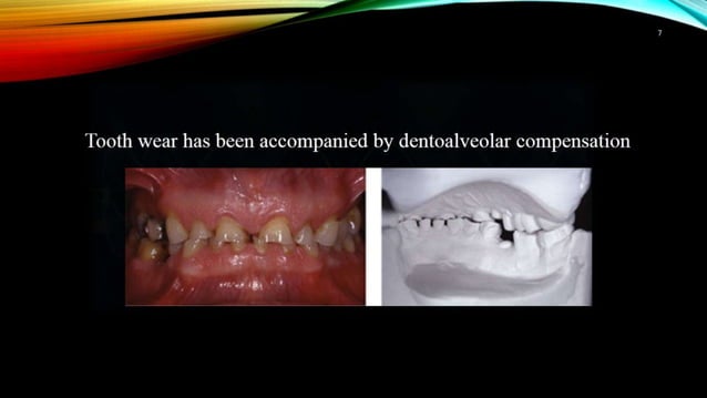 Teeth wear management introduction | PPTX