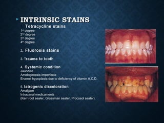 teeth bleaching | PPT