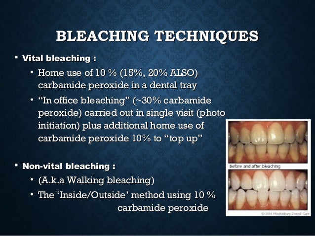 Teeth Bleaching