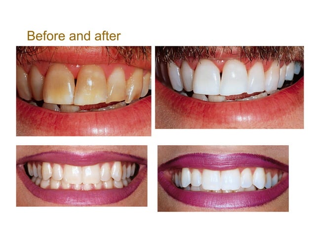 Teeth whitening lecture(1) | PPT