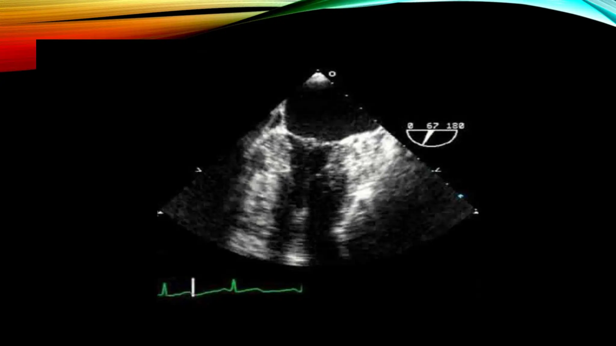 TEE VIEWS transesophageal echocardiography views.pptx