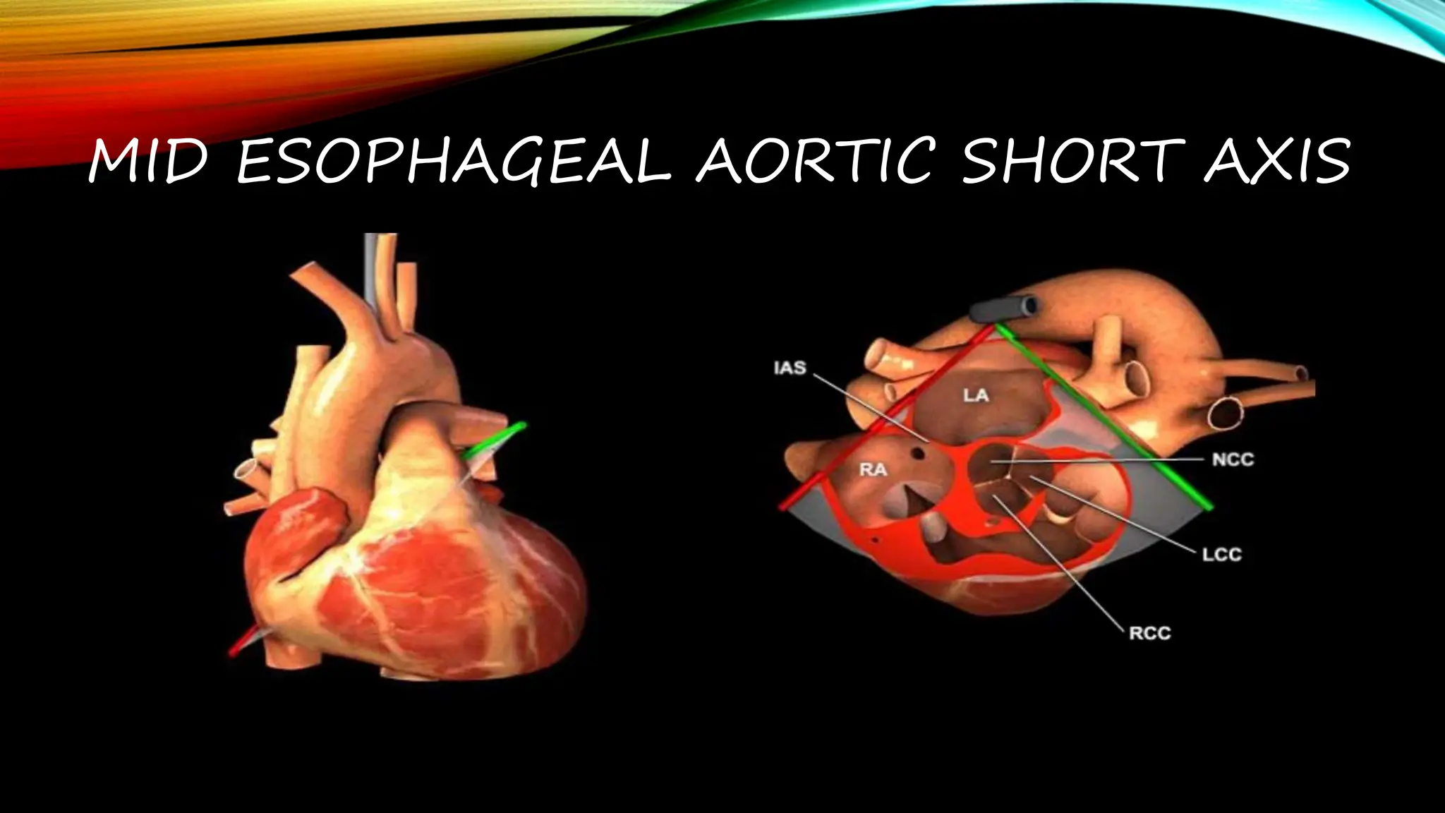 TEE VIEWS transesophageal echocardiography views.pptx