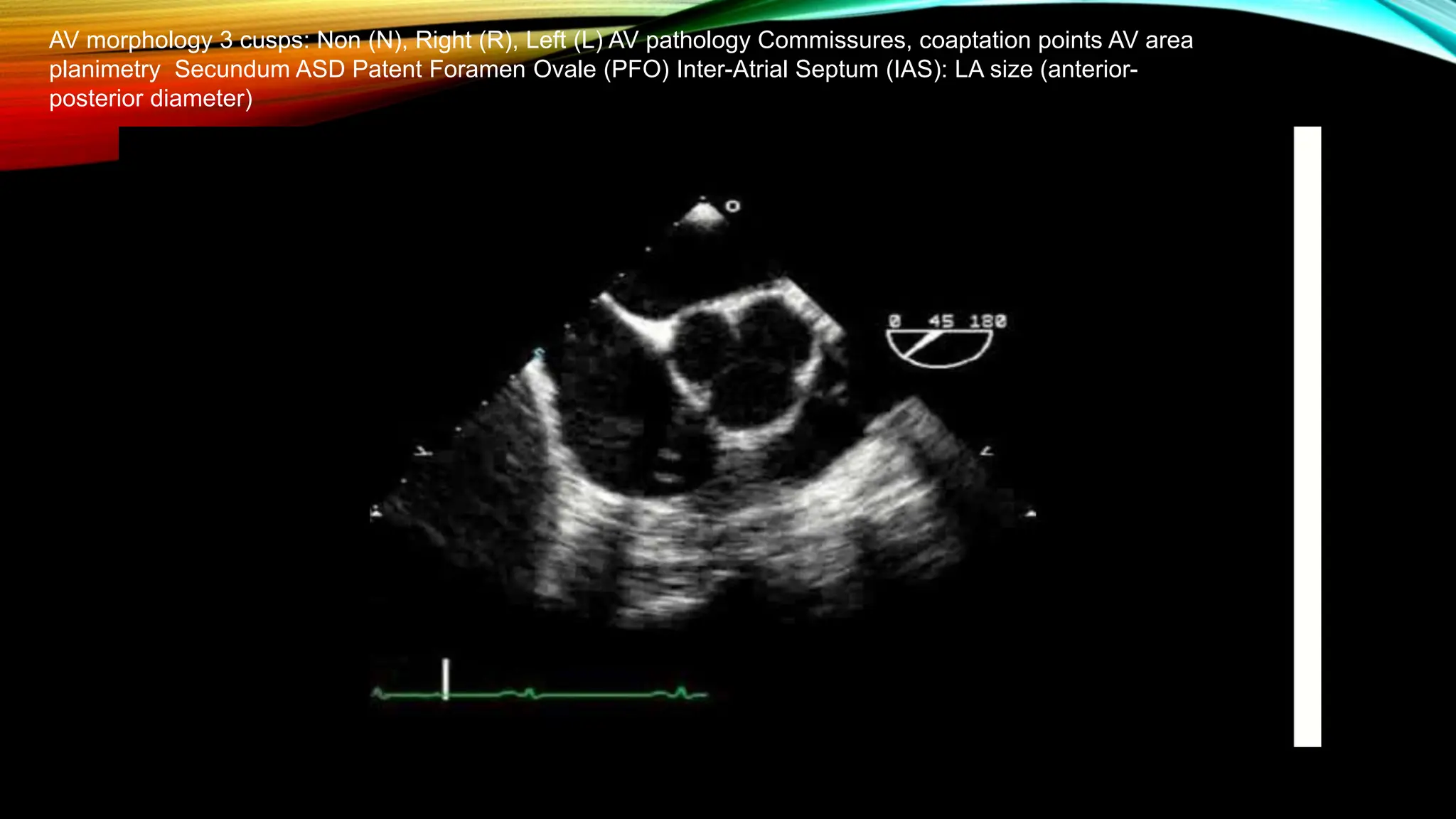 TEE VIEWS transesophageal echocardiography views.pptx