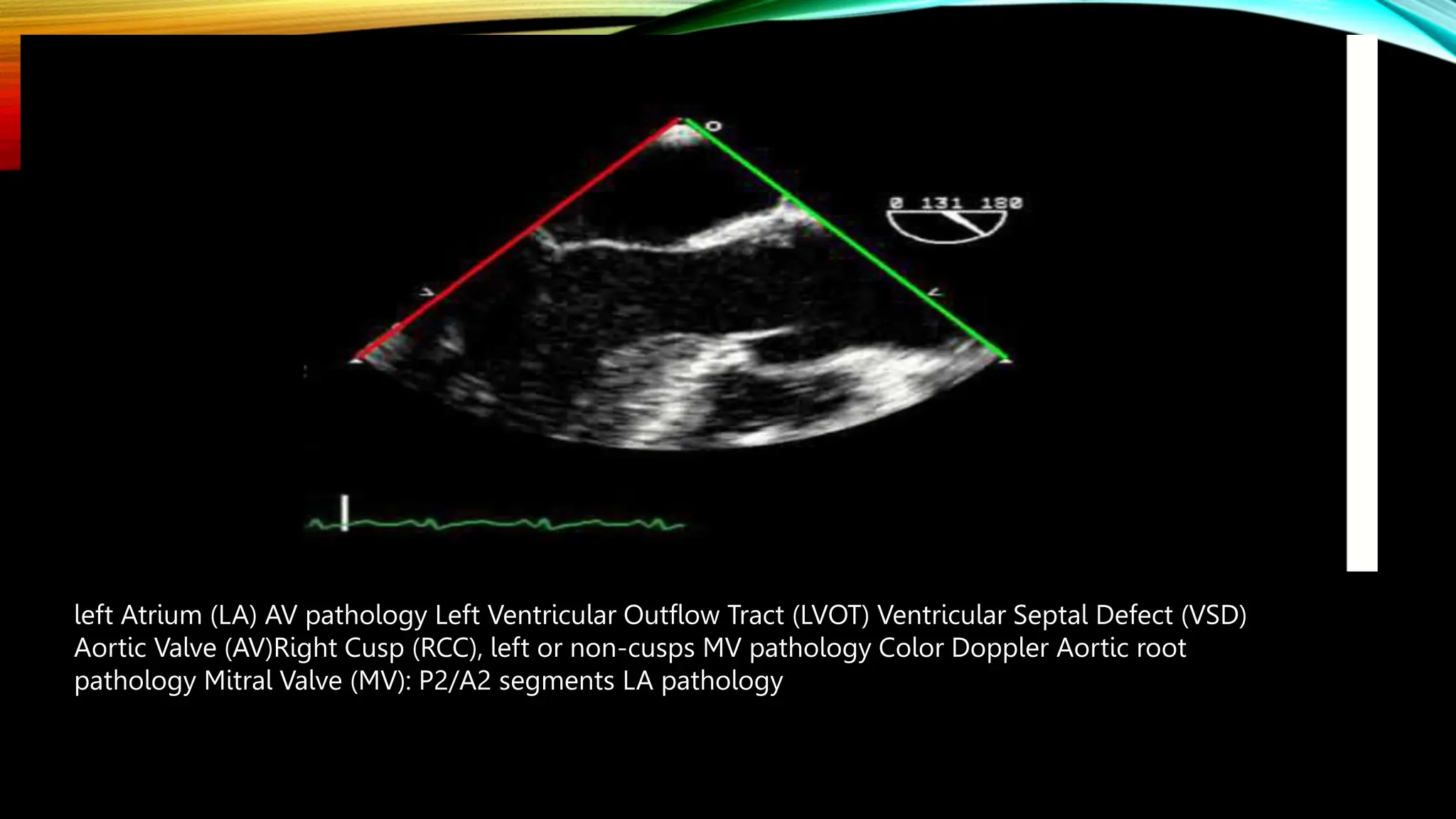 TEE VIEWS transesophageal echocardiography views.pptx