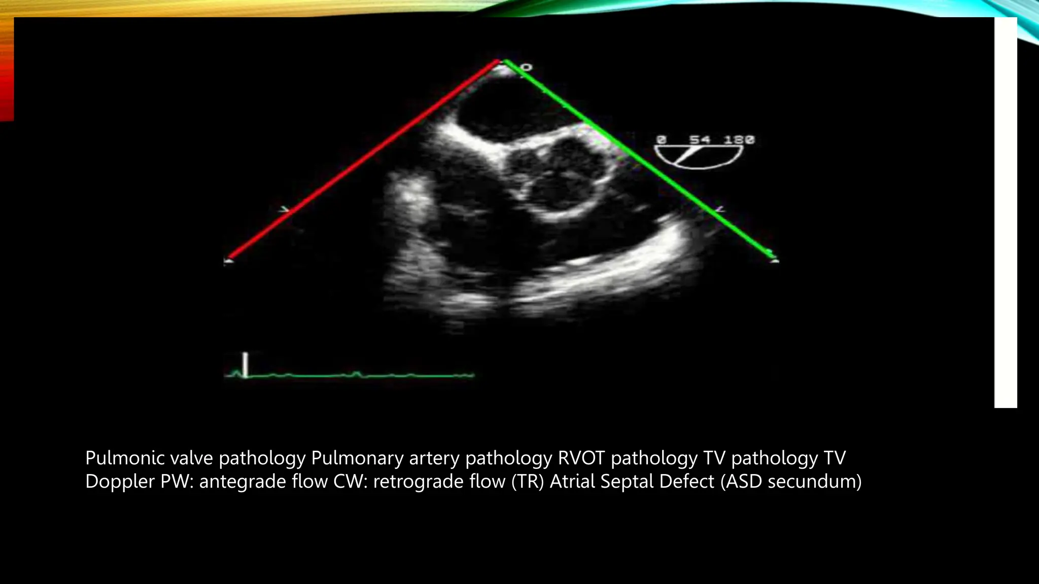 TEE VIEWS transesophageal echocardiography views.pptx