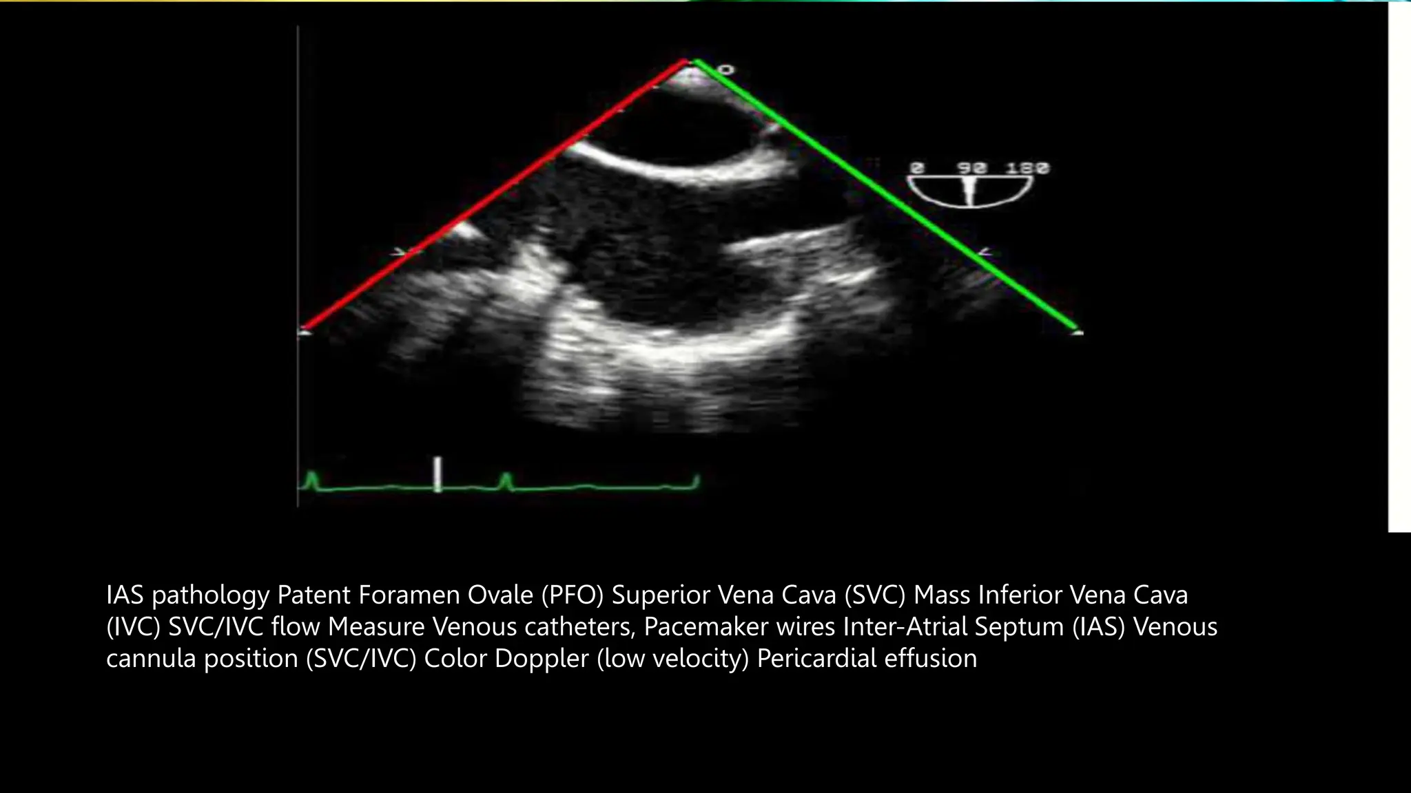 TEE VIEWS transesophageal echocardiography views.pptx