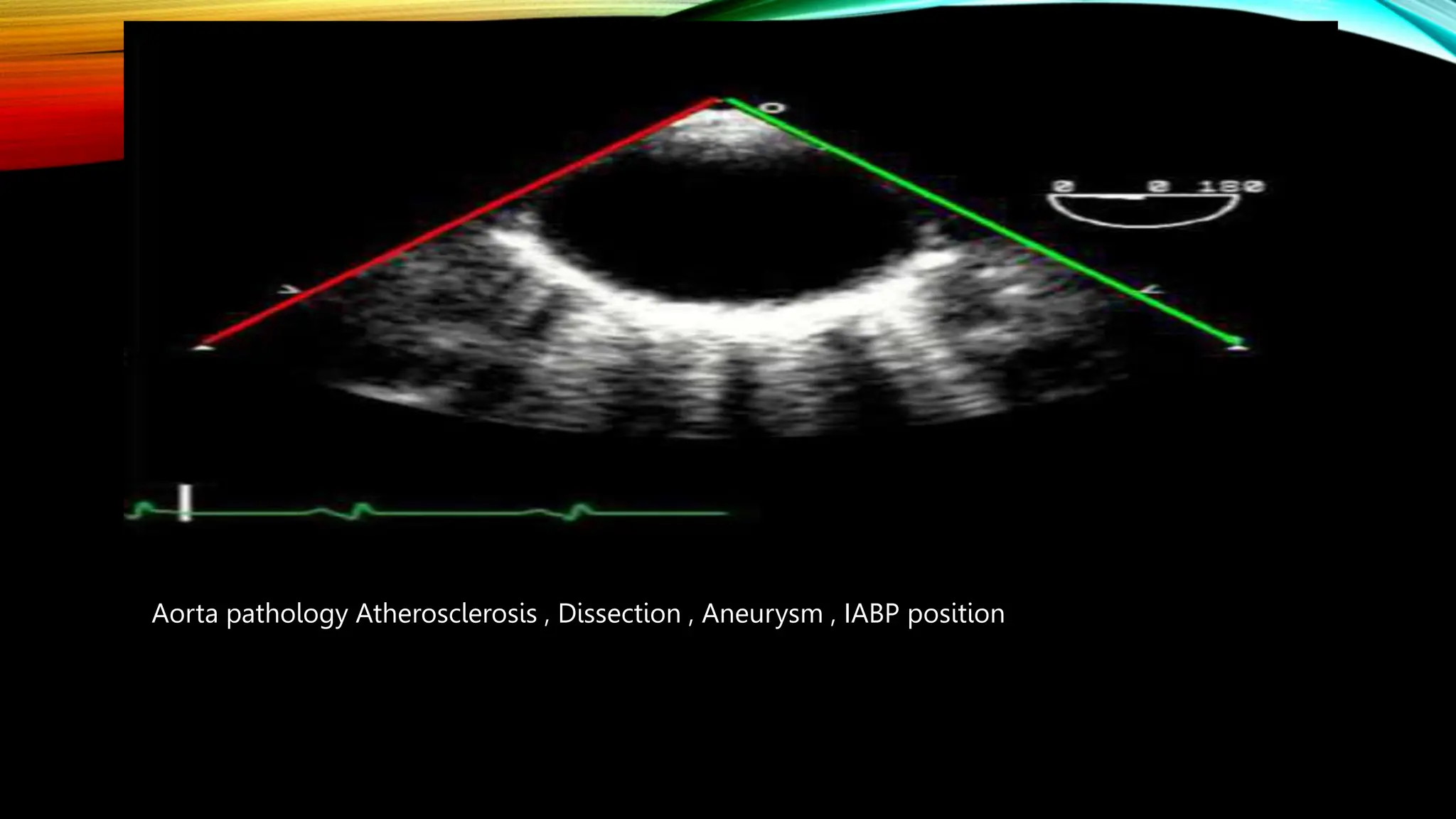 TEE VIEWS transesophageal echocardiography views.pptx