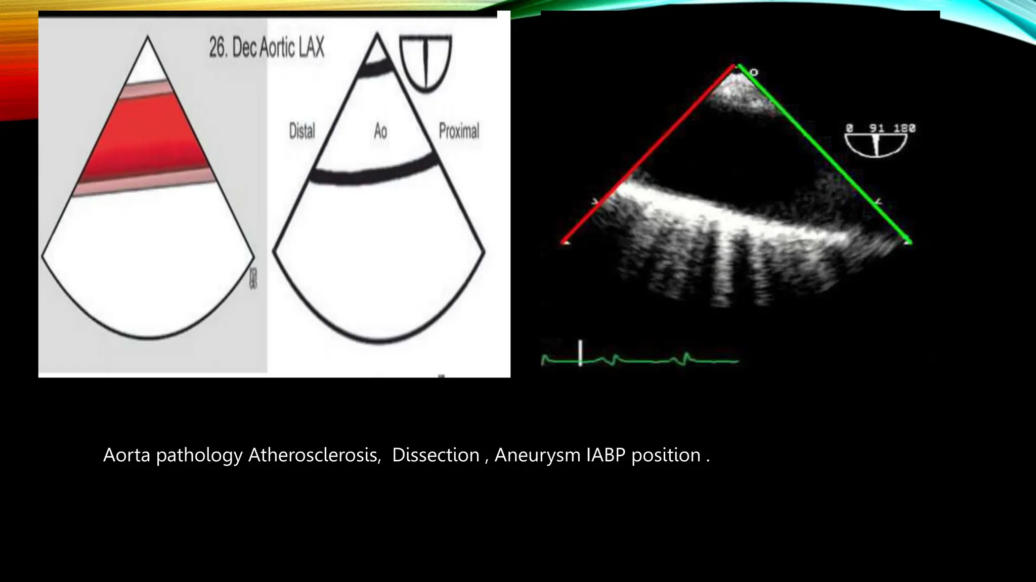 TEE VIEWS transesophageal echocardiography views.pptx
