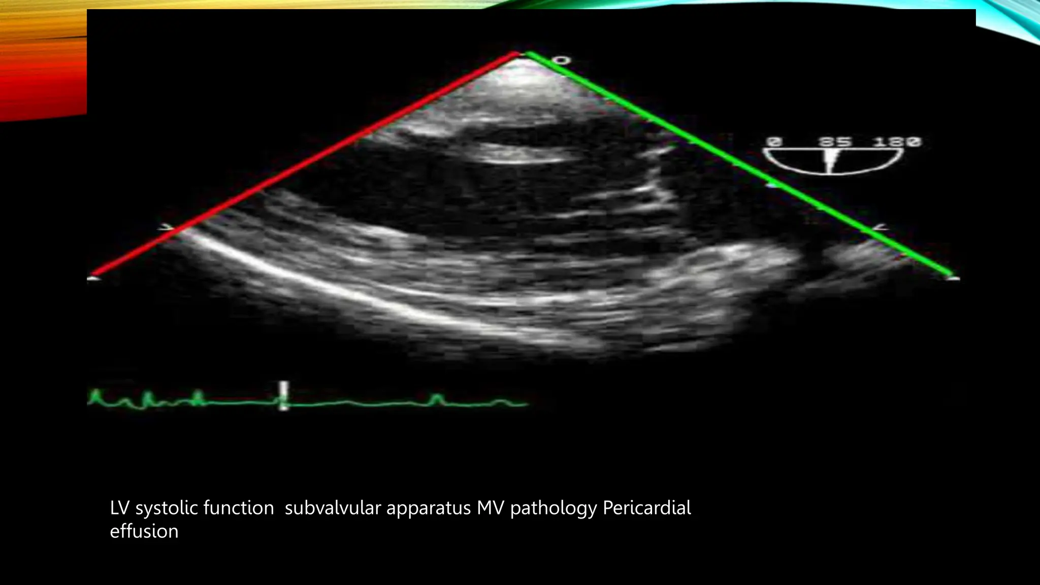 TEE VIEWS transesophageal echocardiography views.pptx