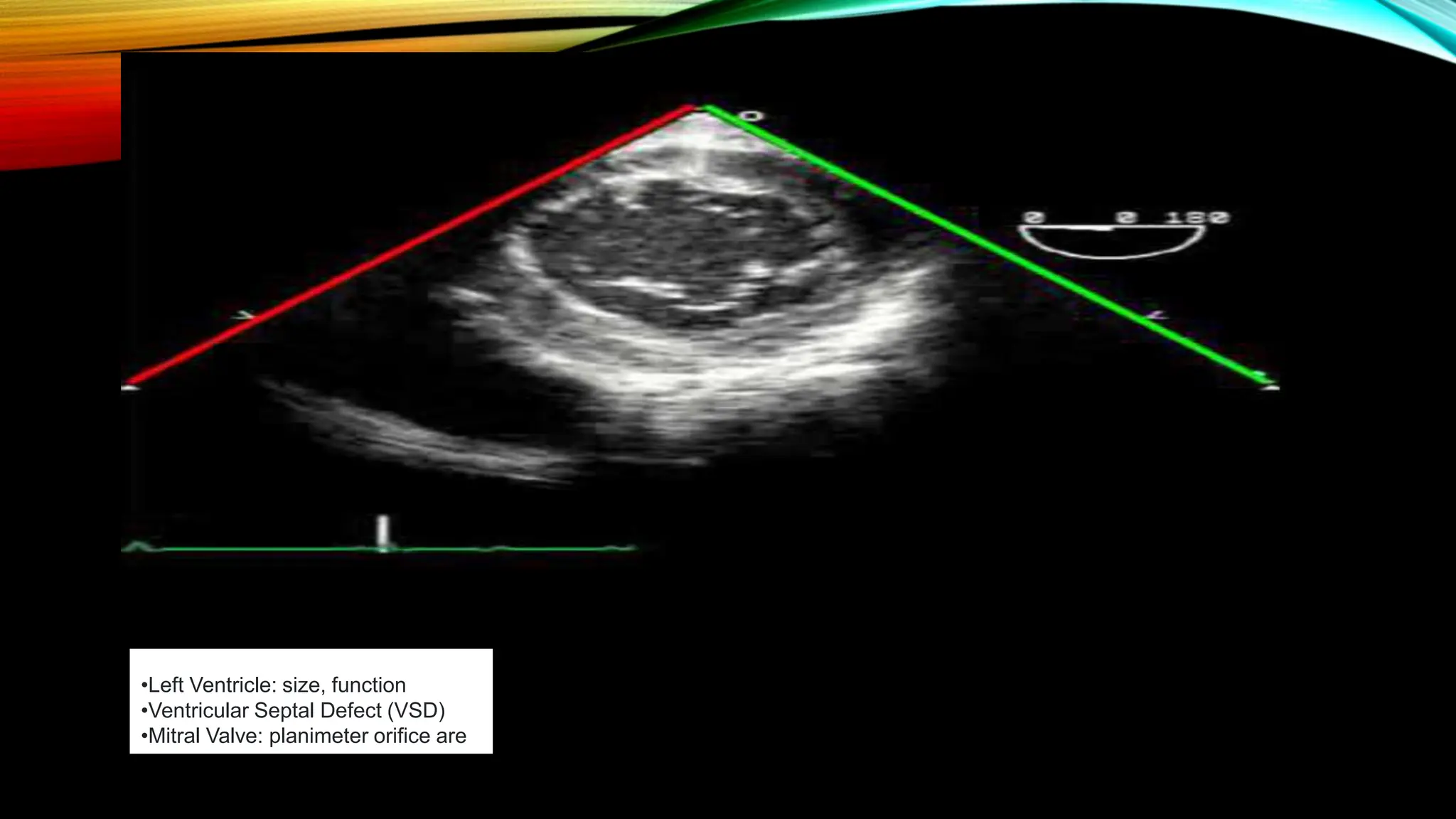 TEE VIEWS transesophageal echocardiography views.pptx
