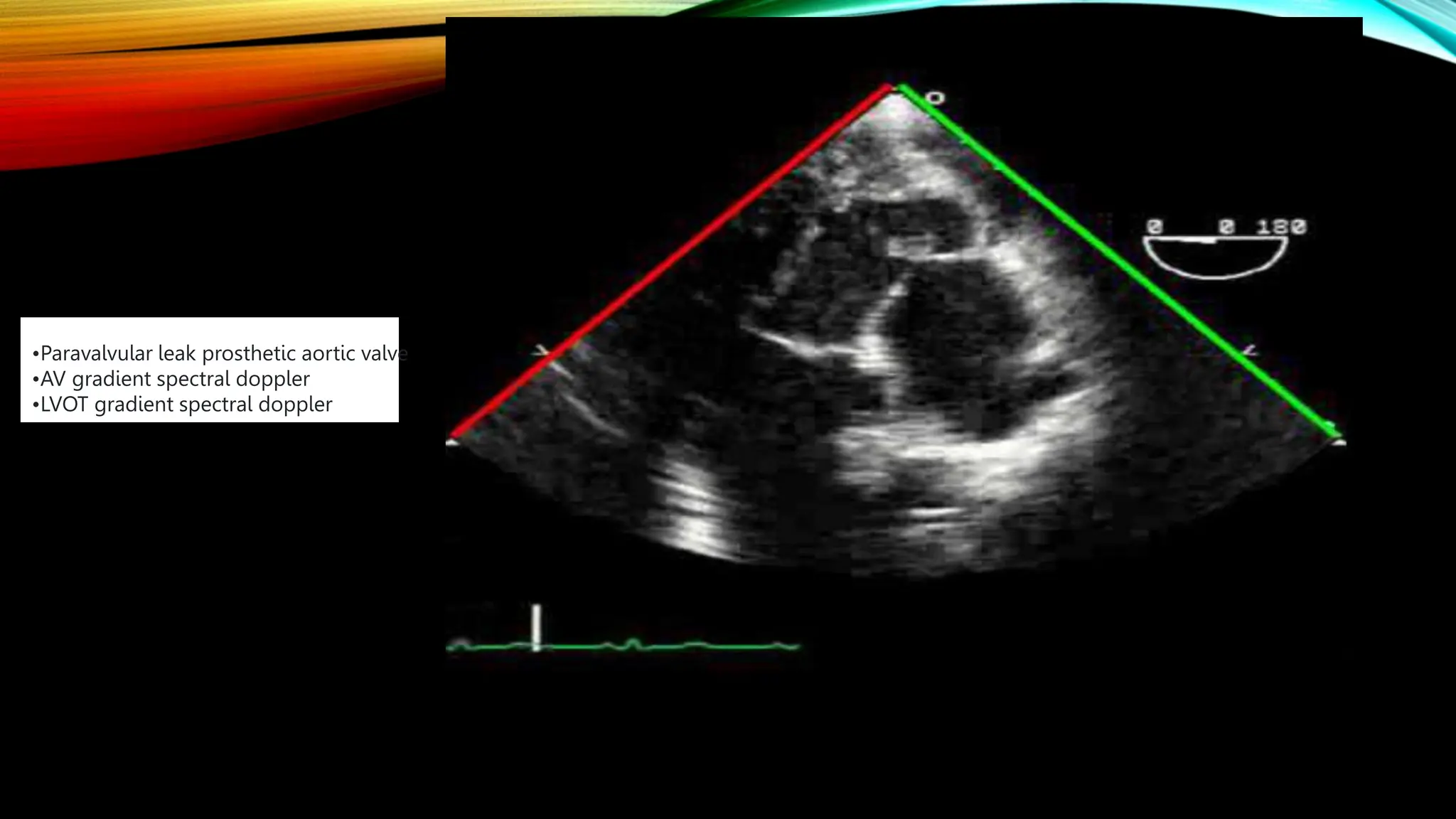 TEE VIEWS transesophageal echocardiography views.pptx