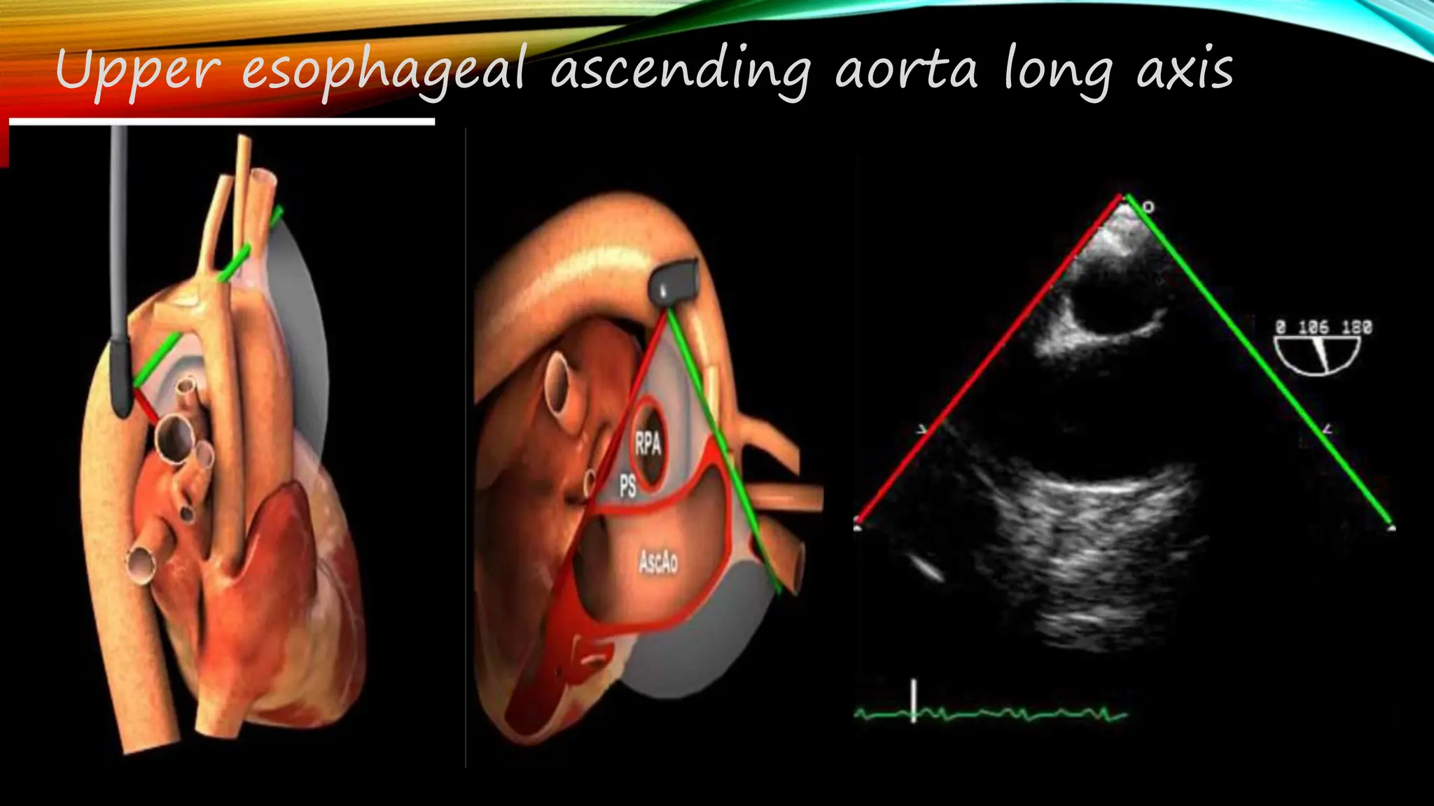 TEE VIEWS transesophageal echocardiography views.pptx