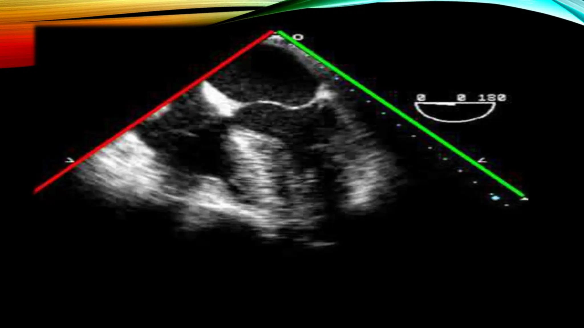 TEE VIEWS transesophageal echocardiography views.pptx