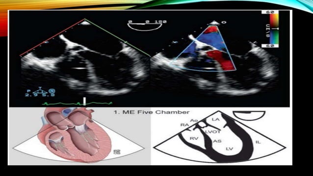 TEE VIEWS transesophageal echocardiography views.pptx | Heart and ...