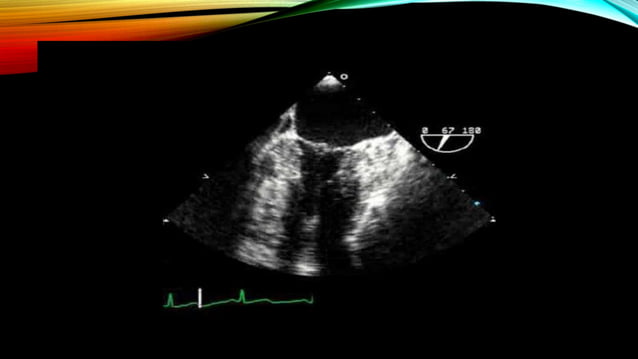 TEE VIEWS transesophageal echocardiography views.pptx | Heart and ...