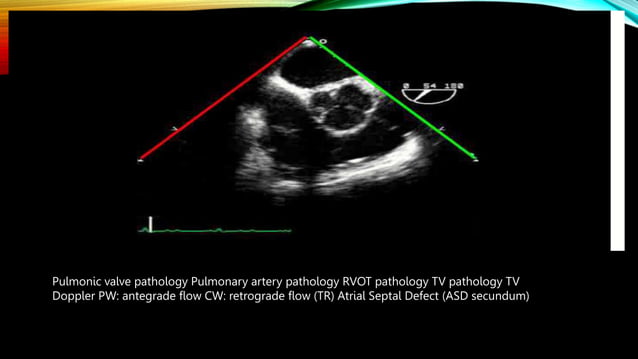 TEE VIEWS transesophageal echocardiography views.pptx | Heart and ...
