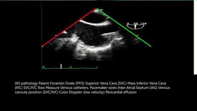 TEE VIEWS transesophageal echocardiography views.pptx | Heart and ...