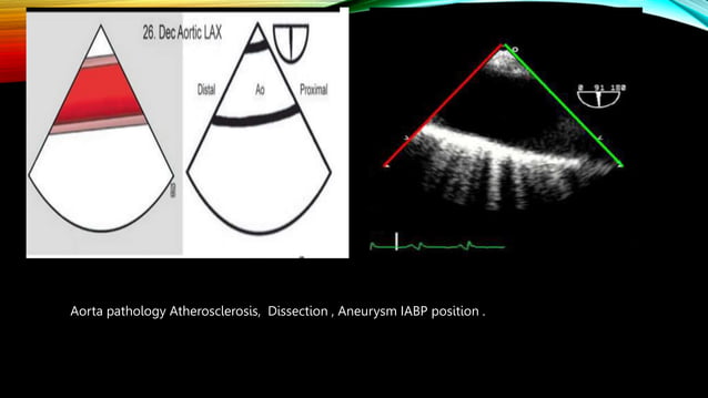 TEE VIEWS transesophageal echocardiography views.pptx | Heart and ...