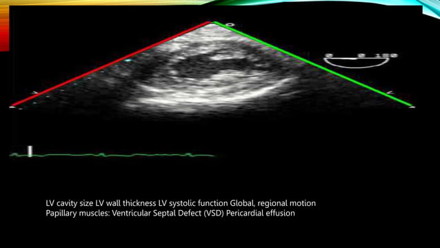 TEE VIEWS transesophageal echocardiography views.pptx | Heart and ...
