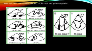TEE VIEWS transesophageal echocardiography views.pptx