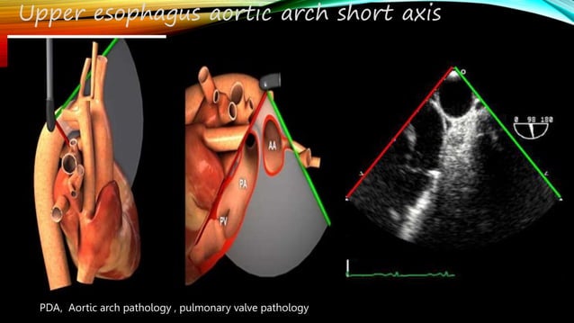 TEE VIEWS transesophageal echocardiography views.pptx | Heart and ...