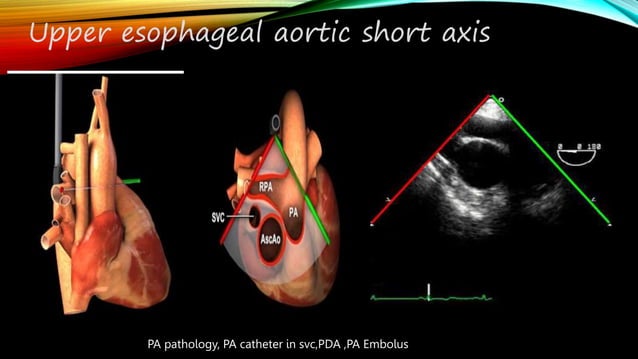 TEE VIEWS transesophageal echocardiography views.pptx | Heart and ...